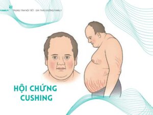 Hội chứng Cushing – TRUNG TÂM NỘI TIẾT