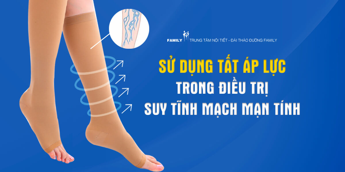 Sử dụng tất áp lực trong điều trị suy tĩnh mạch mạn tính – TRUNG TÂM ...